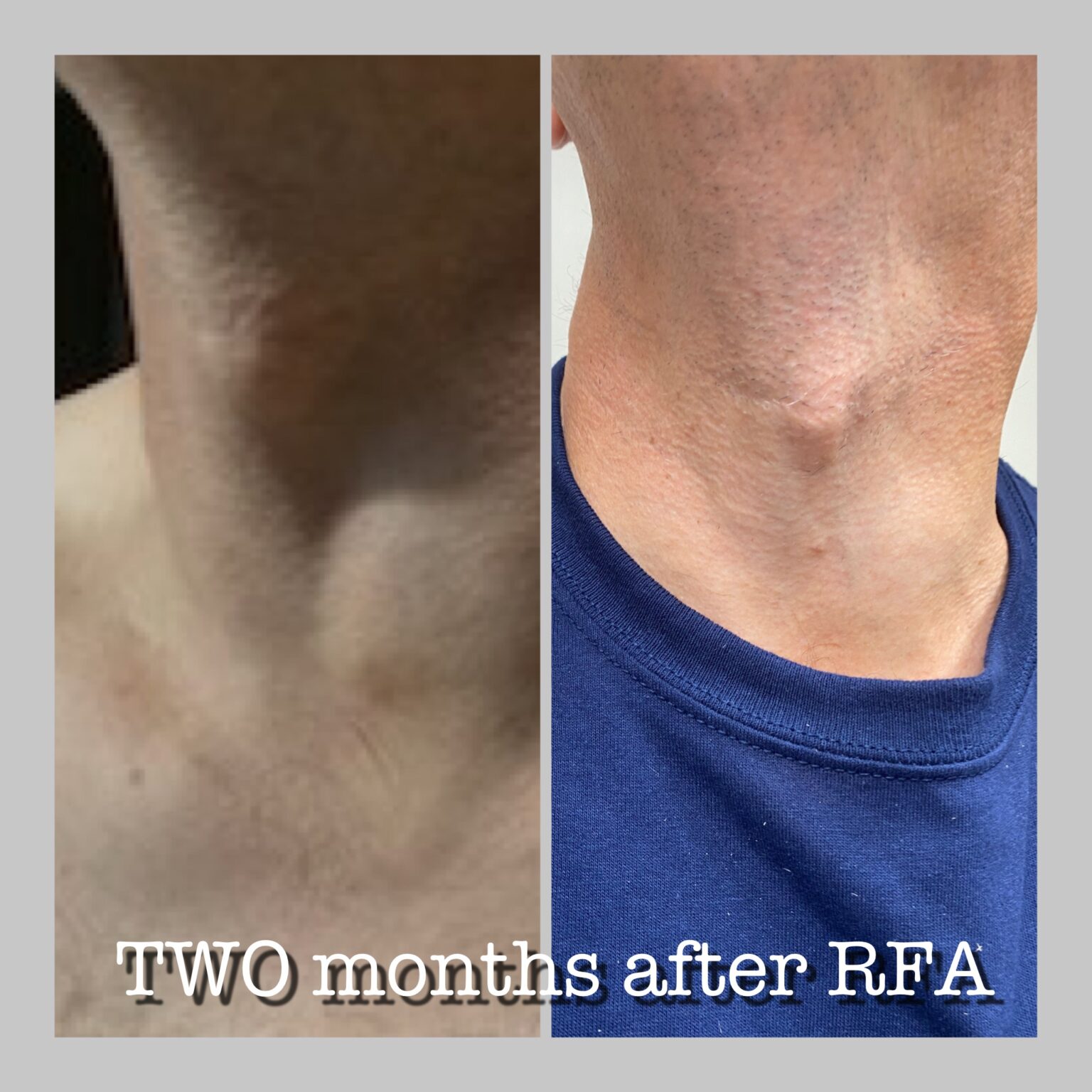 Still Thinking About Thyroid RFA ! - rfathyroidtn.com